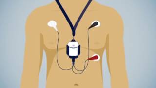 MCOT patch – Philips Ambulatory Monitoring and Diagnostics