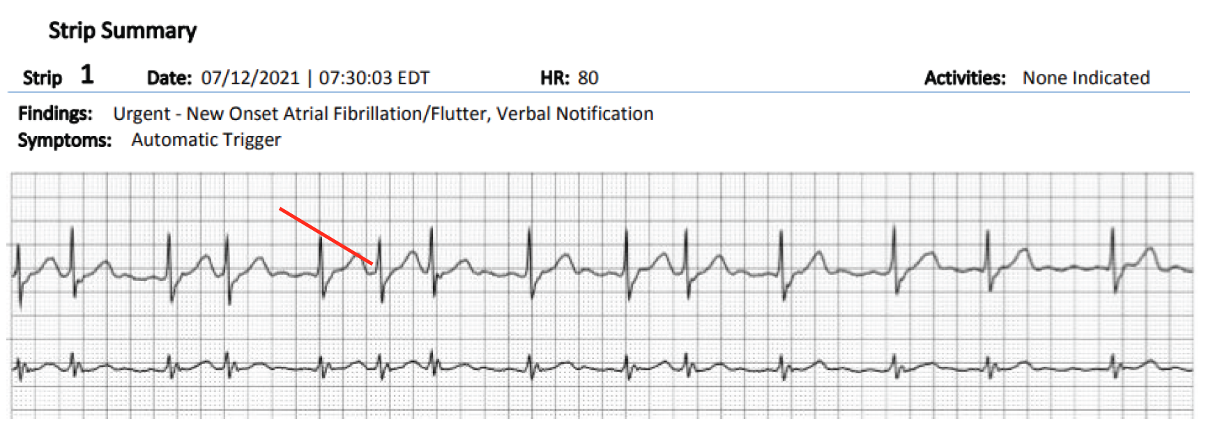 patient-ecg – Philips Ambulatory Monitoring and Diagnostics